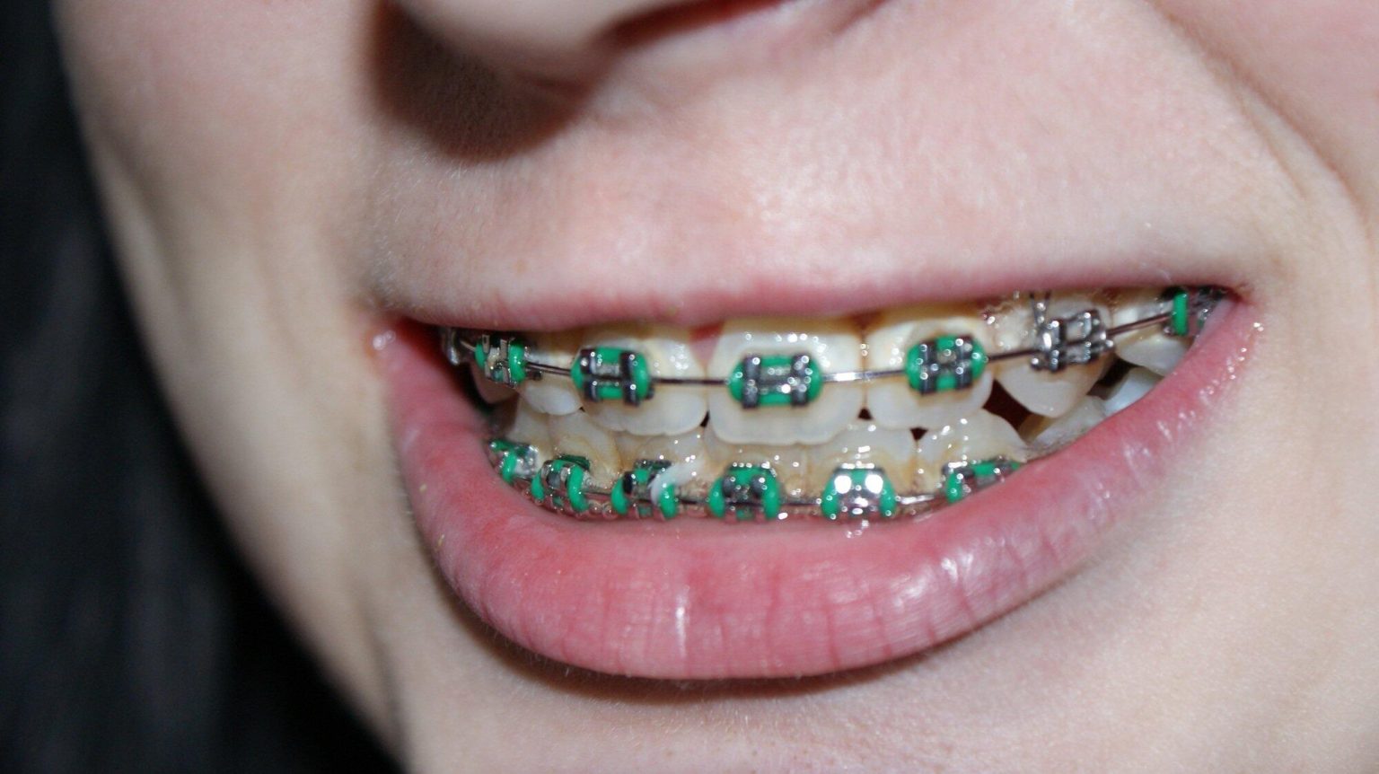 Dental Braces 101: Types, Costs, and Treatment Options - 2A Magazine